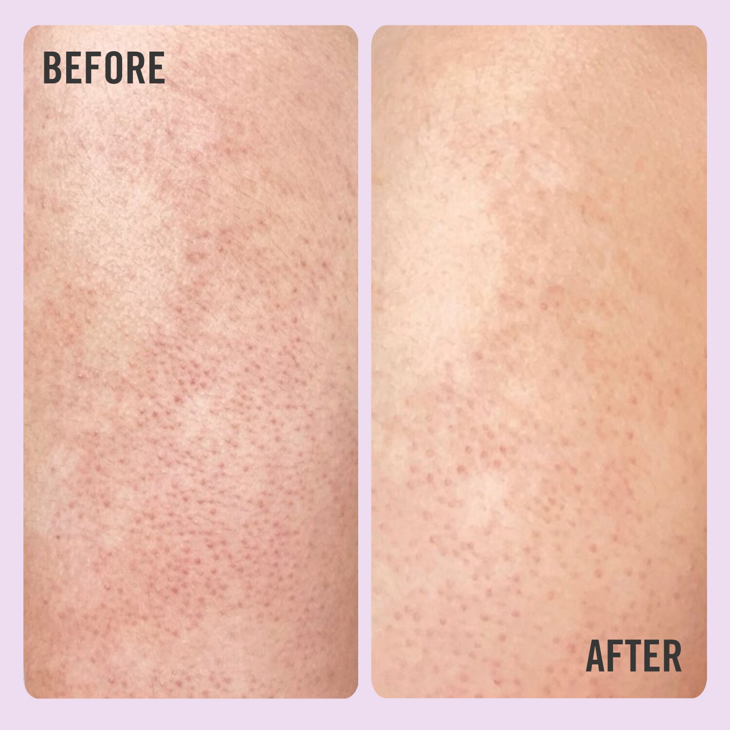 KP Bump Eraser Body Scrub with 10% AHA - Scrub corpo con AHA di FIRST ...